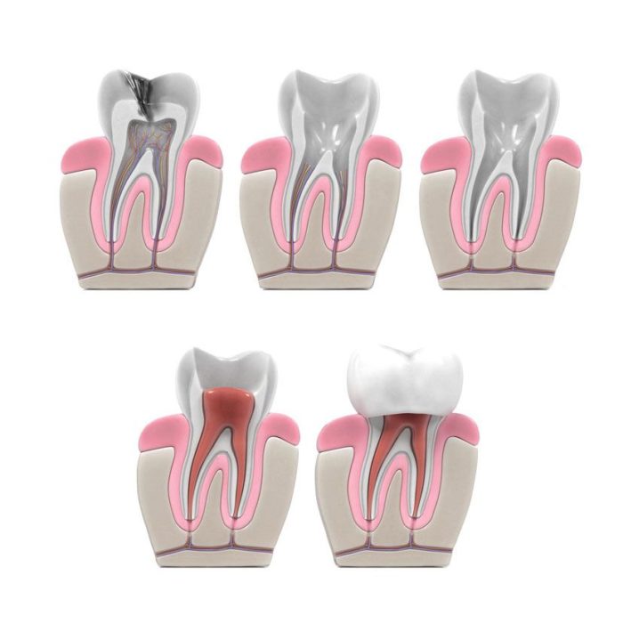 Dentisterie Casselman Dental Clinic | Restore Damaged Teeth With Root ...